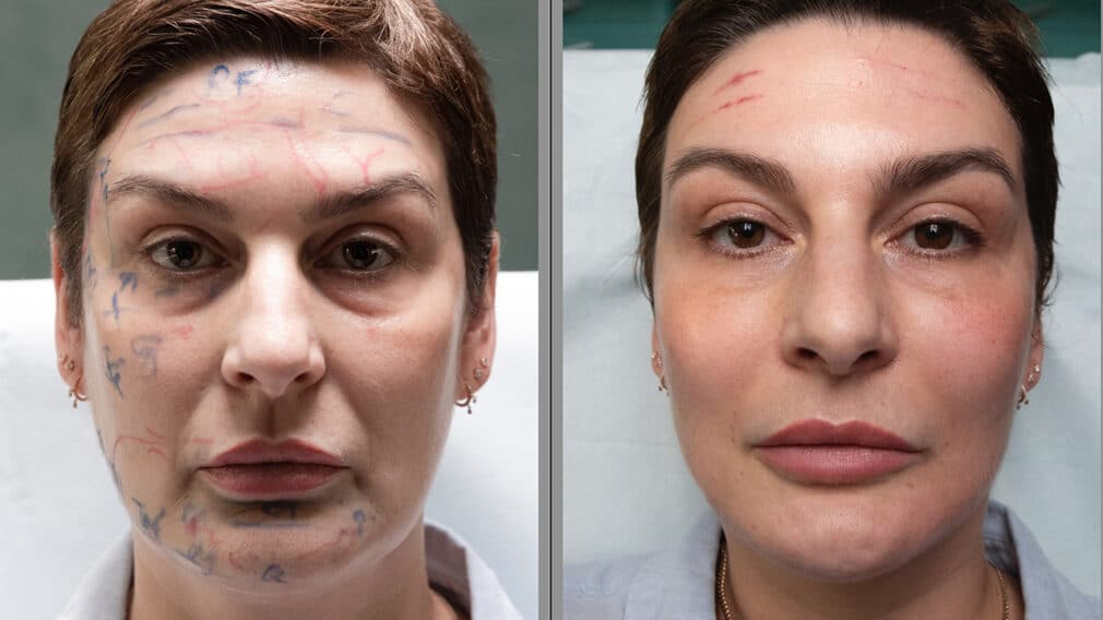 Mes dernières injections : Full face à l’acide hyaluronique - Mon blog ...