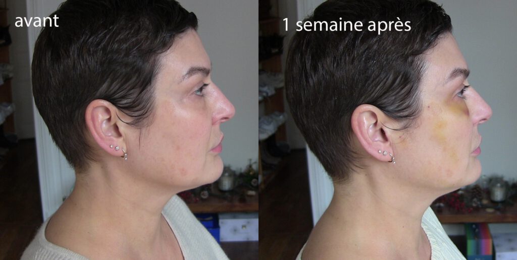 Je Me Suis Fait Poser Des Fils Tenseurs Mon Blog De Fillemon Blog De Fille 