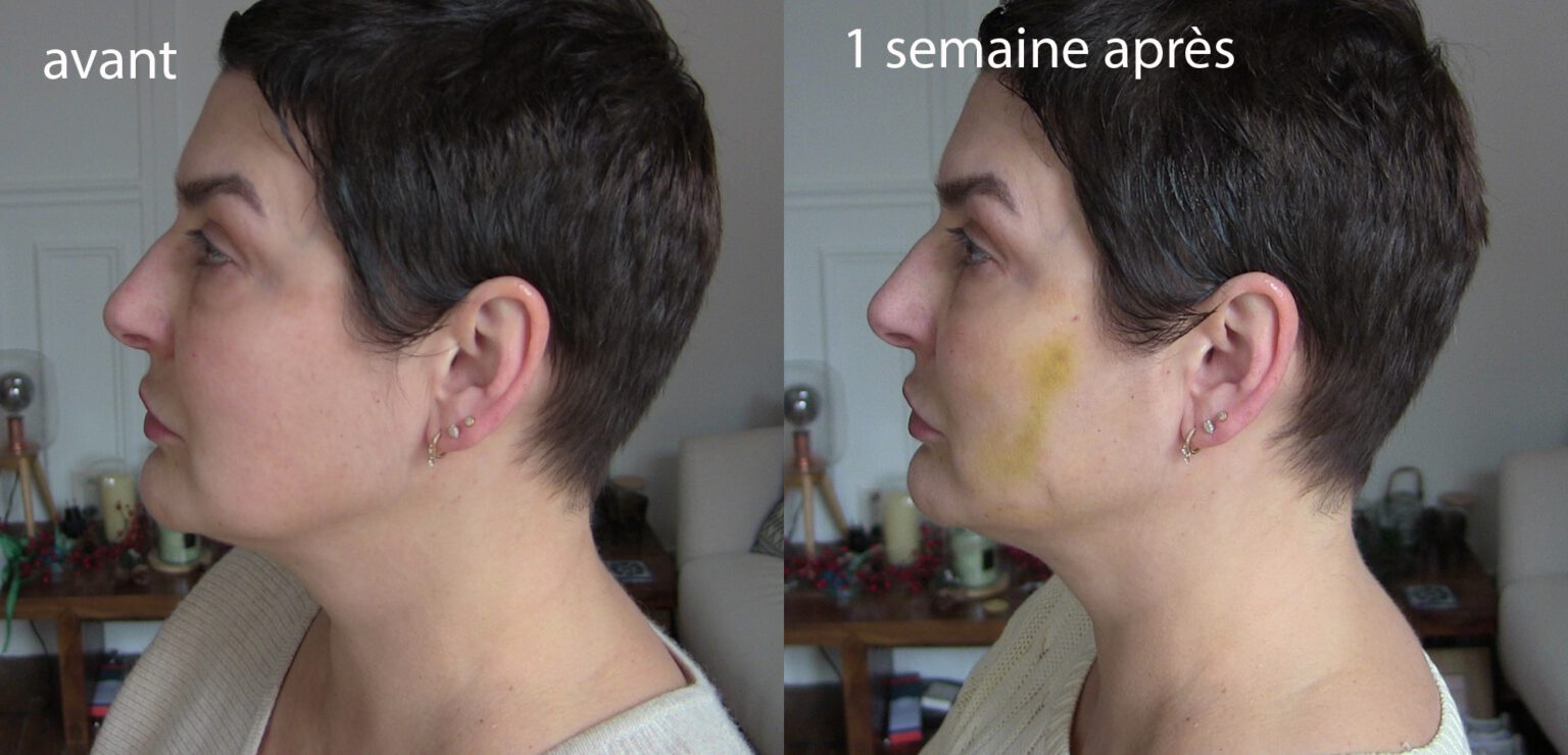 Je Me Suis Fait Poser Des Fils Tenseurs Mon Blog De Fillemon Blog De Fille